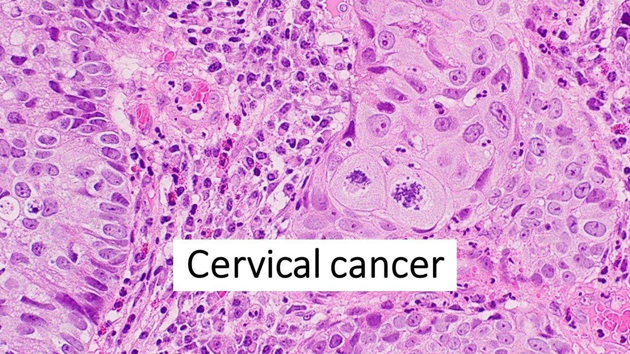 Cervical Pathology Lecture 2 - YouTube