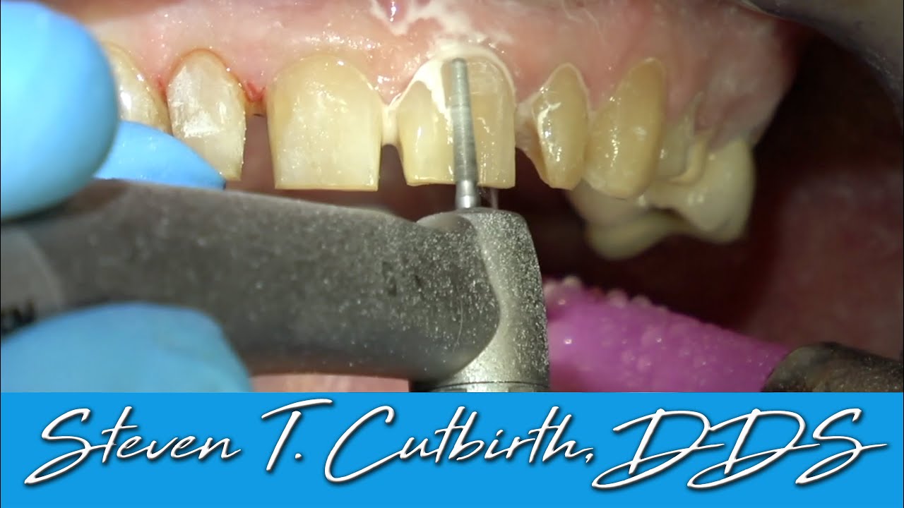 Prepping Maxillary Teeth for Veneers - Dental Minute with Steven T ...
