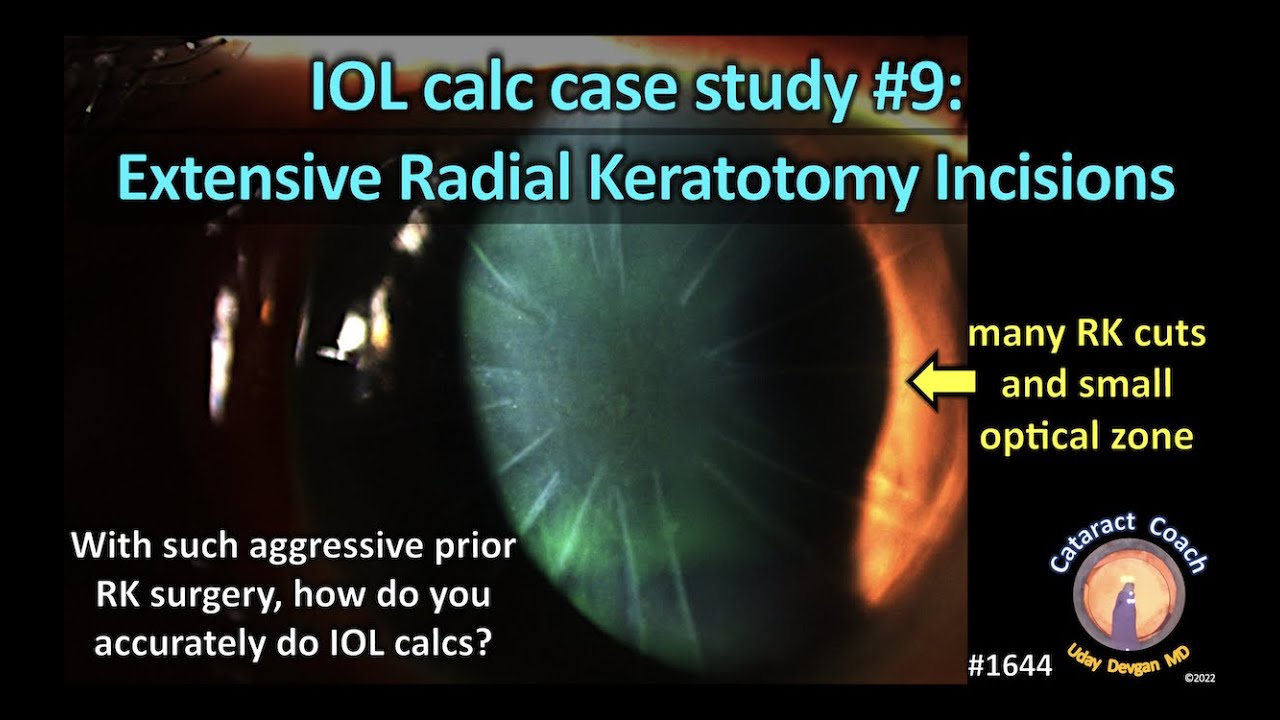 CataractCoach 1644: IOL calc case study 9: extensive radial keratotomy ...