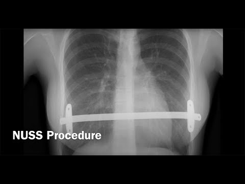 NUSS Procedure - YouTube