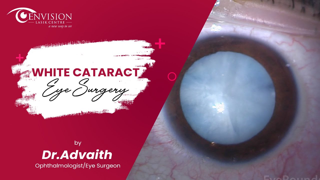 Cataract Eye Surgery | White Cataract | Best Eye Surgery Specialist in ...