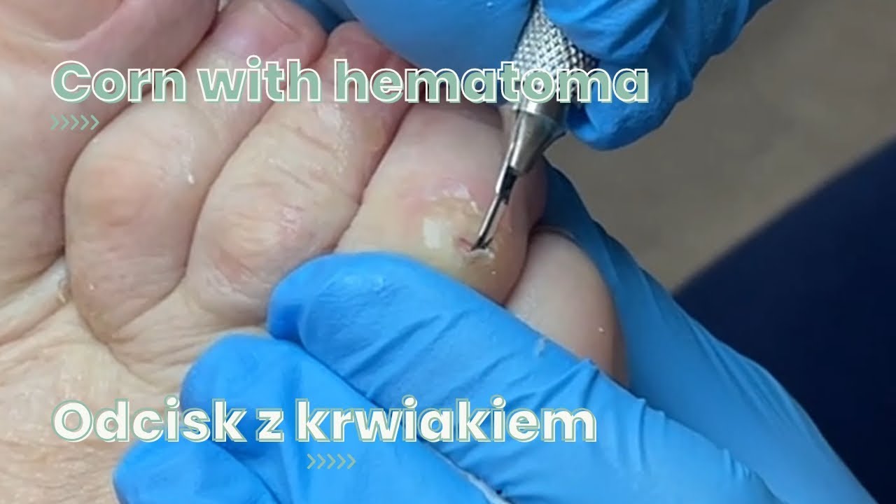 Corn with hematoma / Odcisk z krwiakiem - YouTube