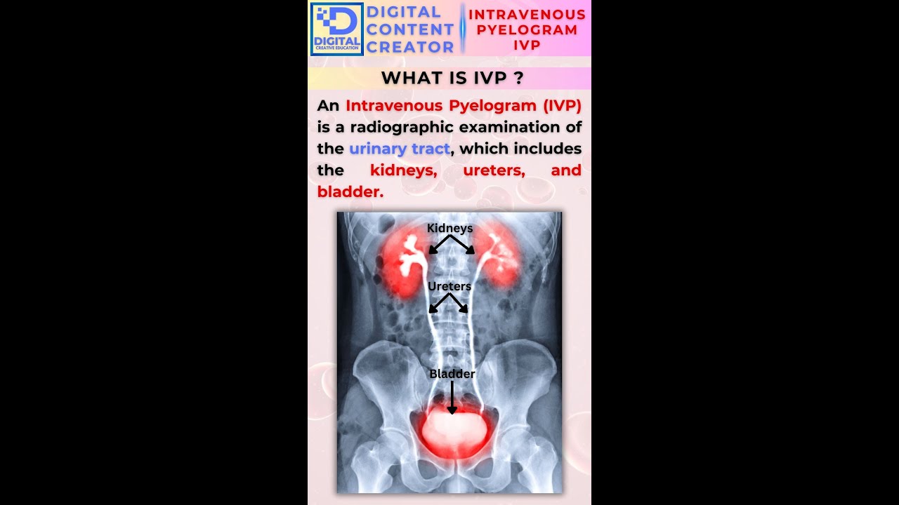 Intravenous Pyeolgram || Understanding Intravenous Pyelogram (IVP ...