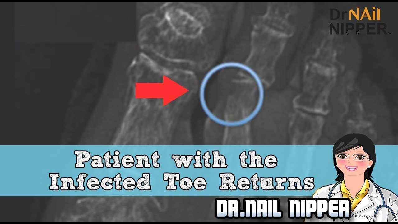 Patient with Infected Toe, Toe Infection Protrusion Returns - YouTube