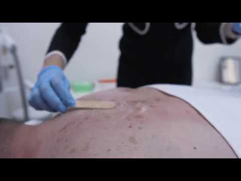 Heraderma Lazerle Cilt Yenileme ve Gözenek Tedavisi