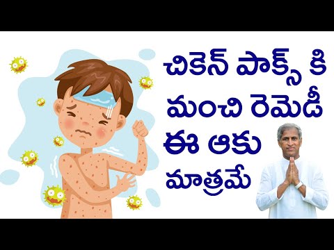 Chicken Pox ( Varicella ): Symptoms, Treatment, & Prevention | Dr Manthena Satyanarayana Raju Videos