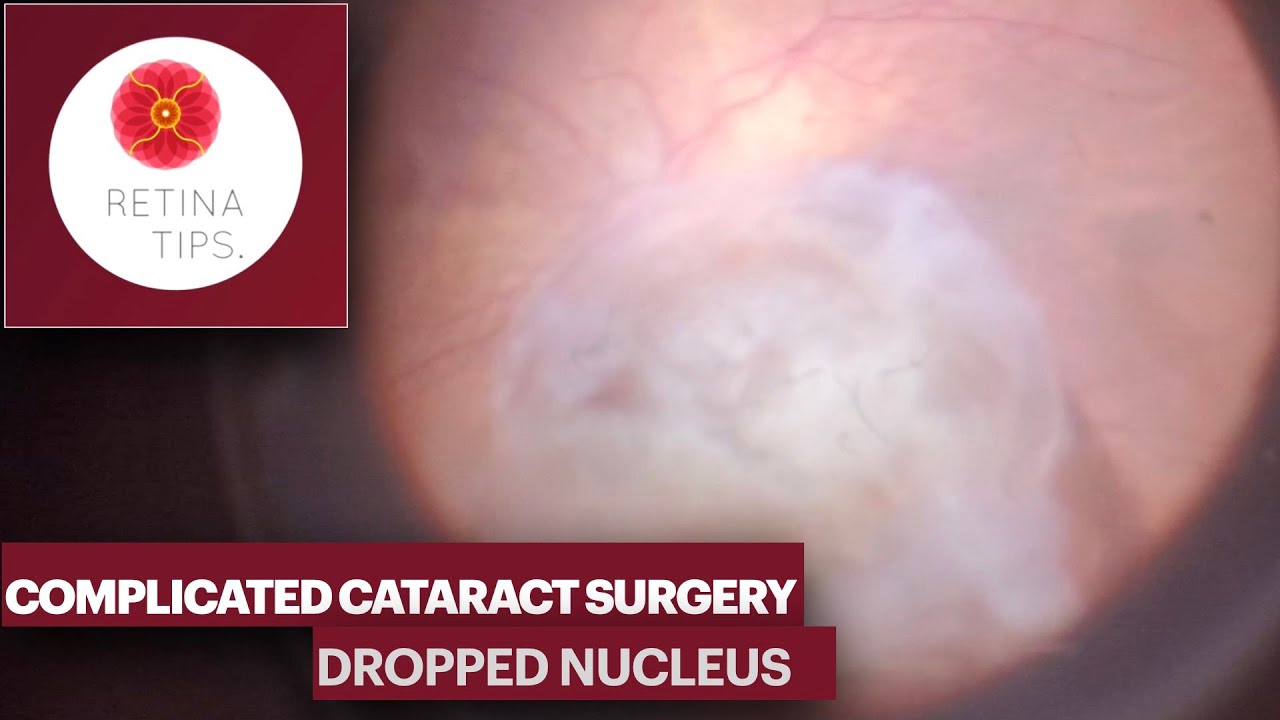 Complicated cataract Surgery: Dropped Nucleus - YouTube