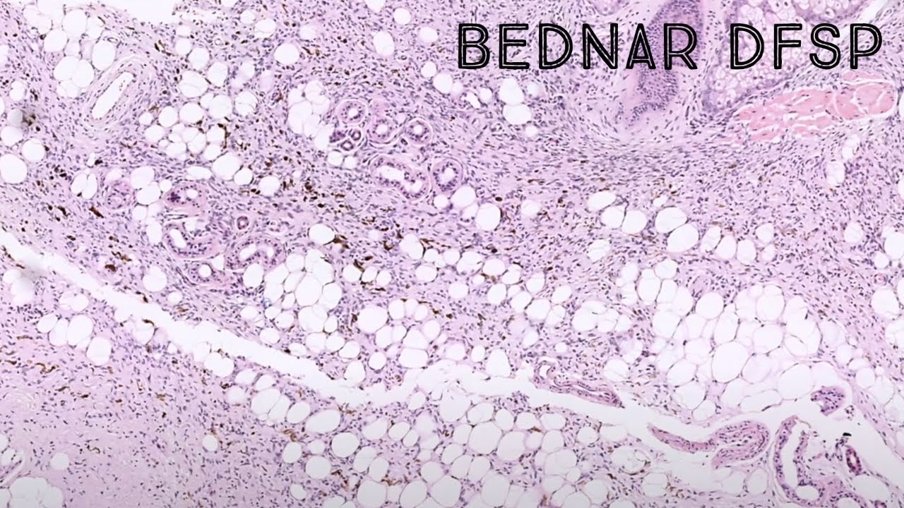 Bednar tumor dermatofibrosarcoma protuberans (DFSP with melanin pigment ...