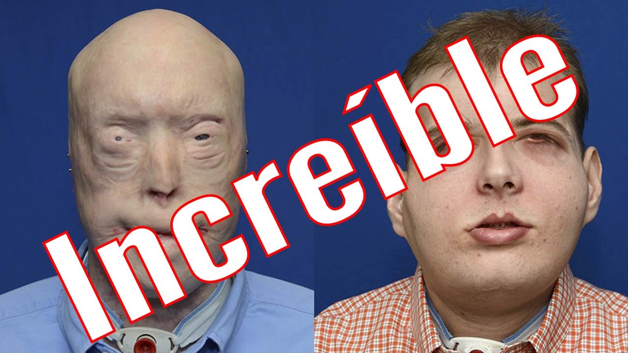 Trasplante de cara antes y despues de Patrick Hardison Hombre bombero ...