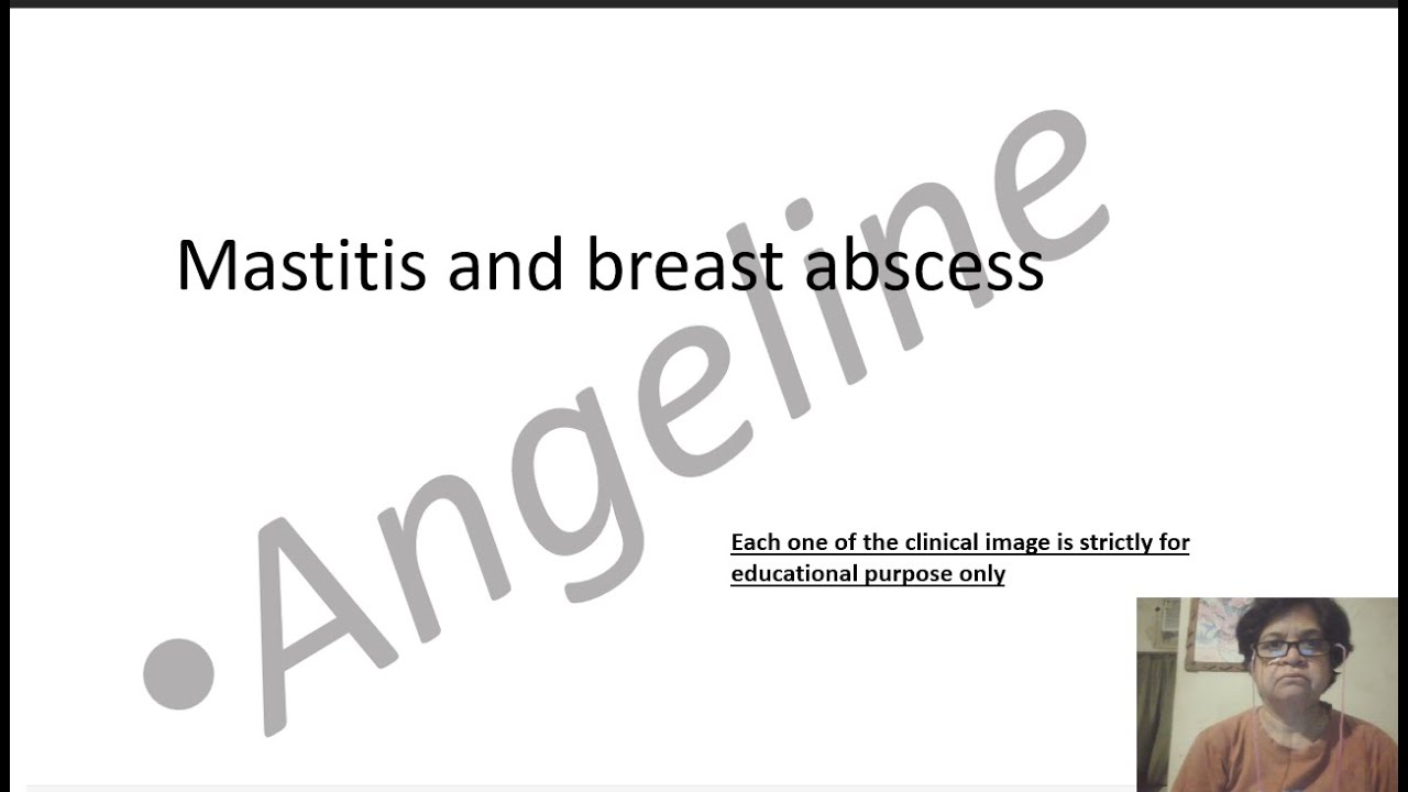 Mastitis and Breast Abscess. Clinical findings and interventions .Real ...
