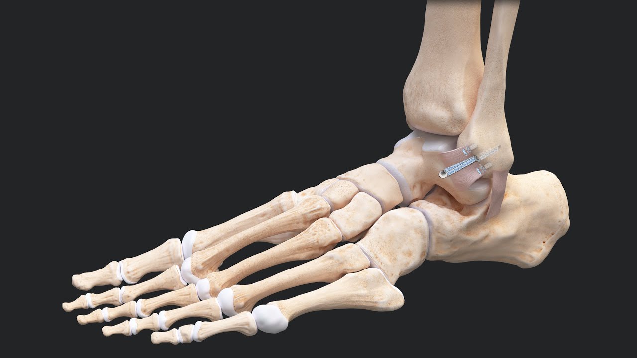 Knotless Brostrom Lateral Ankle Repair With InternalBrace™ Repair and ...