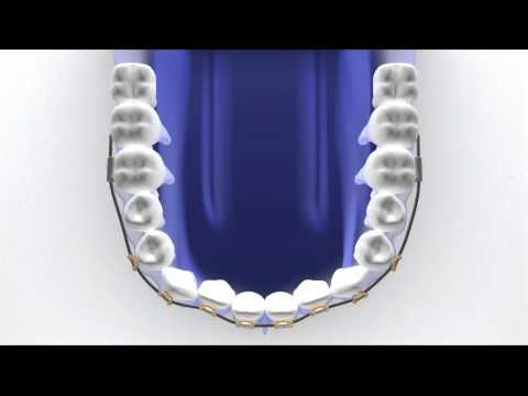 MyDental | FastBraces | Orthodontosis - YouTube