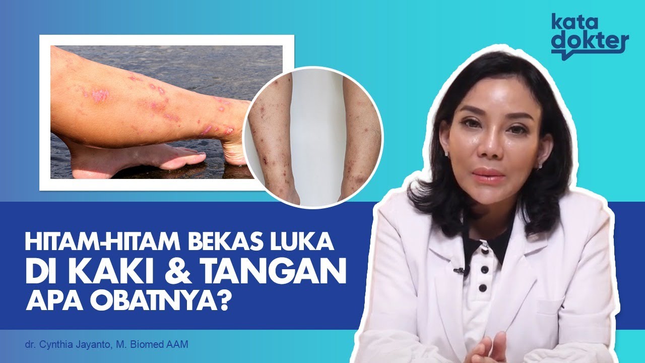 Hitam Hitam Bekas Luka Di Kaki Dan Tangan, Apa Obatnya? | Kata Dokter ...