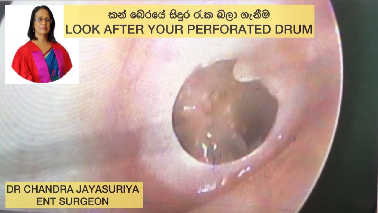 කන් බෙරයේ සිදුරක් තිබෙන විට කුමක් කළ යුතුද? How to look after a ...
