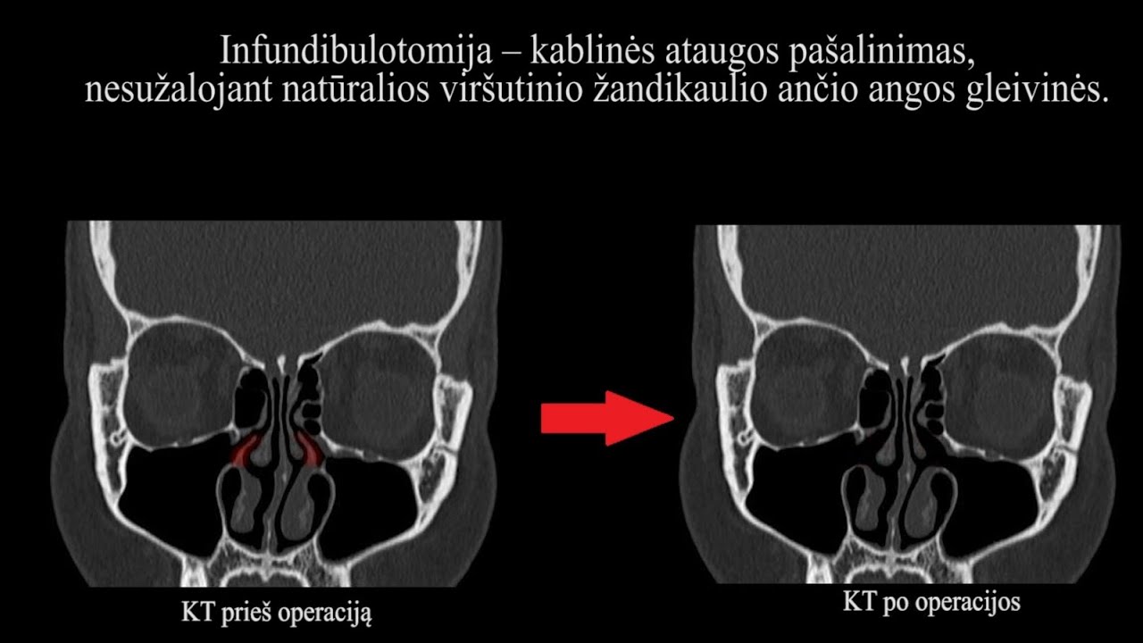 FESS. Infundibulotomia . Infundibulotomija - YouTube