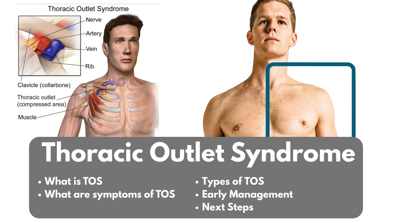 What is Thoracic Outlet Syndrome | Symptoms, Types of TOS, and Early ...