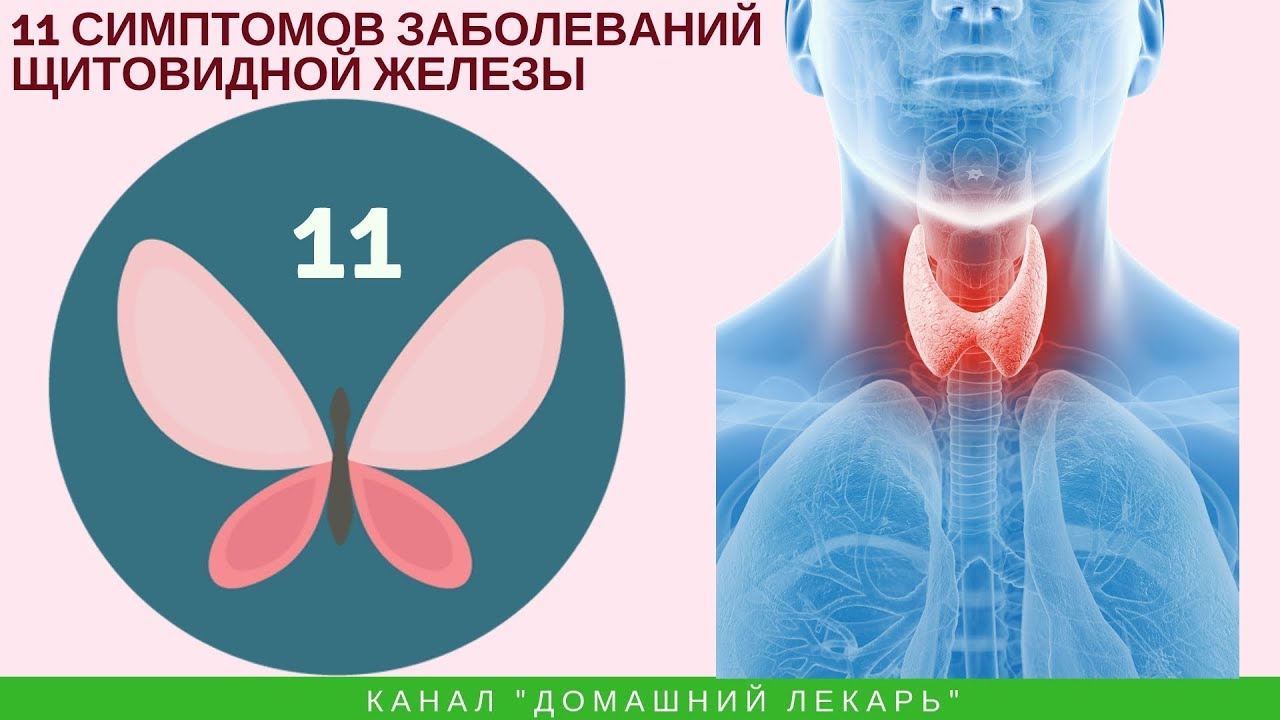 11 симптомов болезни щитовидной железы Домашний лекарь выпуск №210