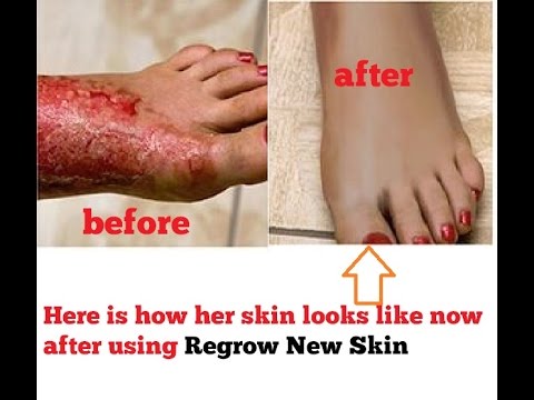 Regrow New Skin back fast on face Regrow New Skin reviews - YouTube