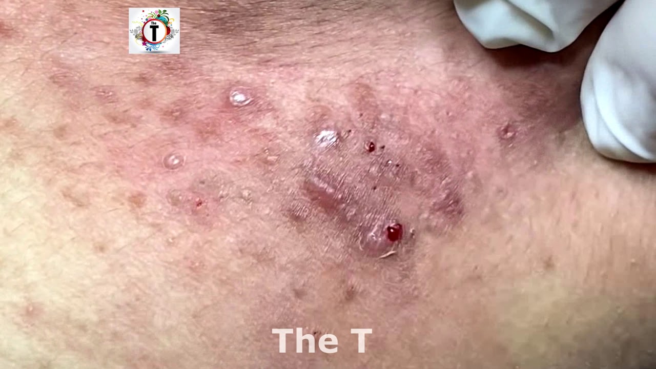 Hien Nguyen Acne Sac Dep Spa Đà Nẵng Spa Acne Treatment 39 Youtube