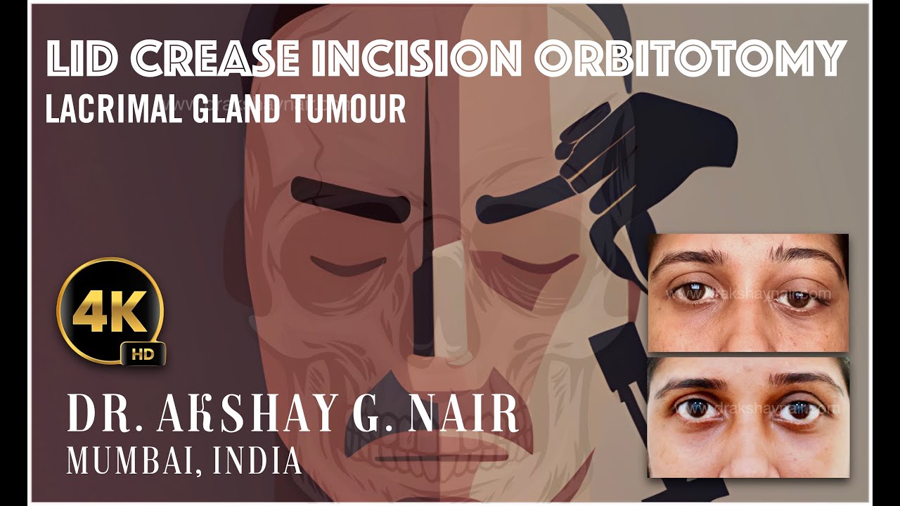Lateral Orbitotomy for Lacrimal Gland Tumour - Lid Crease Approach: Dr ...