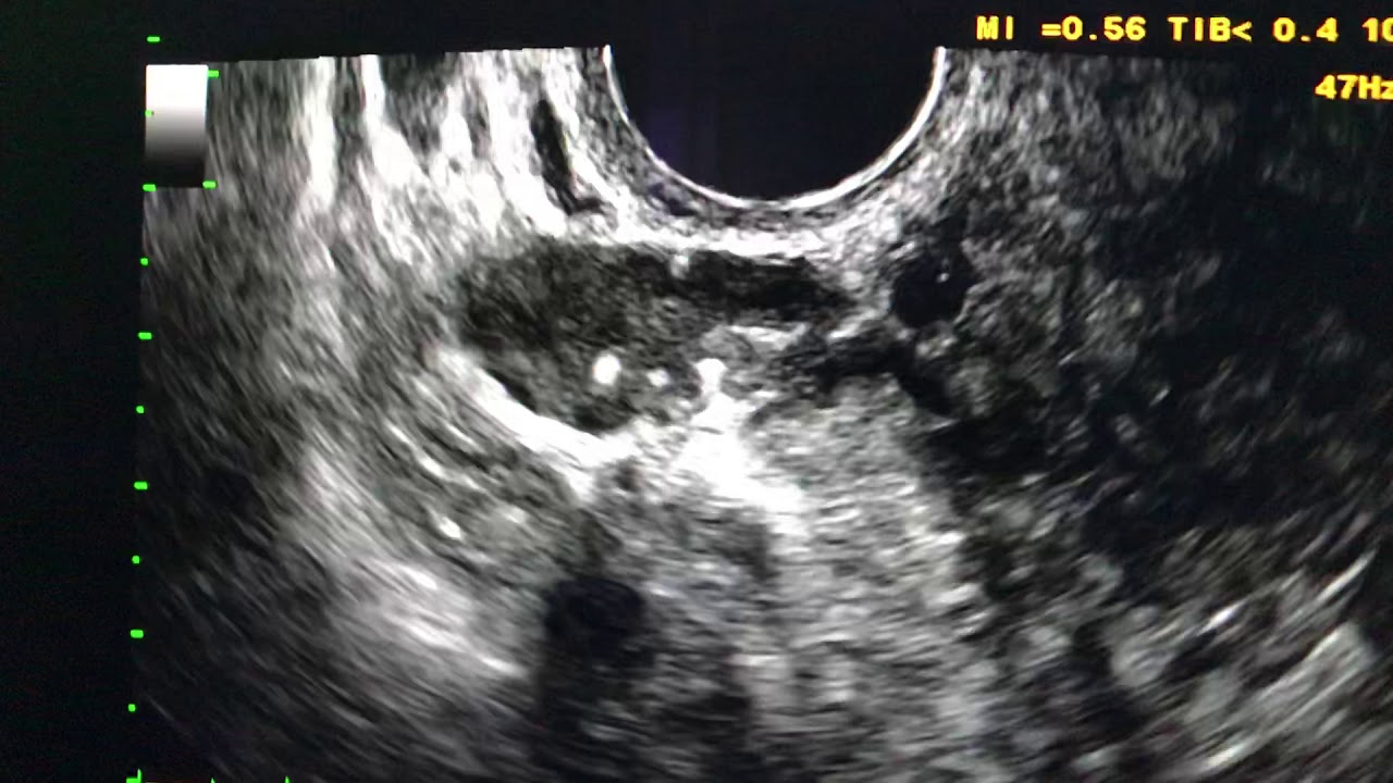 Echogenic Foci In Ovary USG Ultrasound YouTube