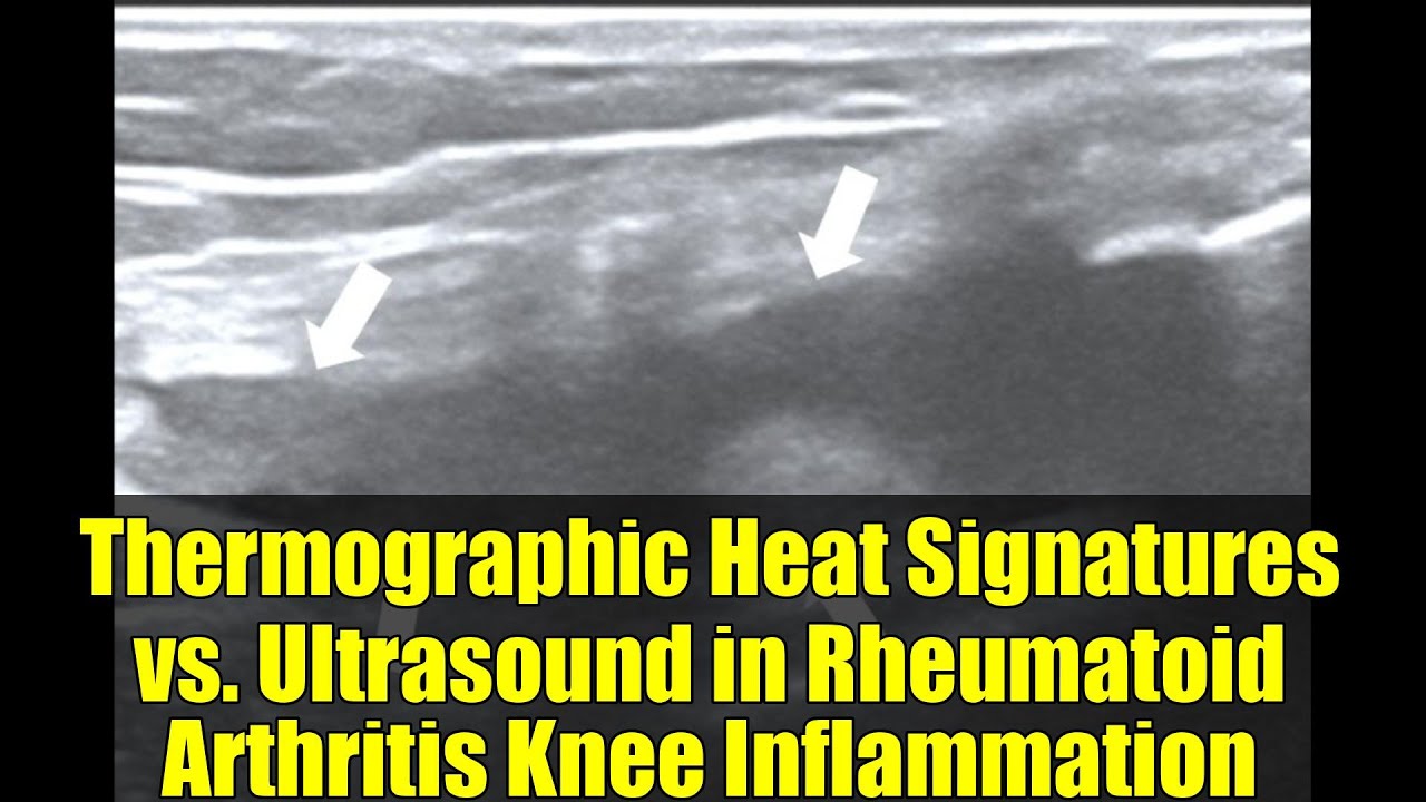 Thermographic Heat Signatures vs. Ultrasound in Rheumatoid Arthritis ...