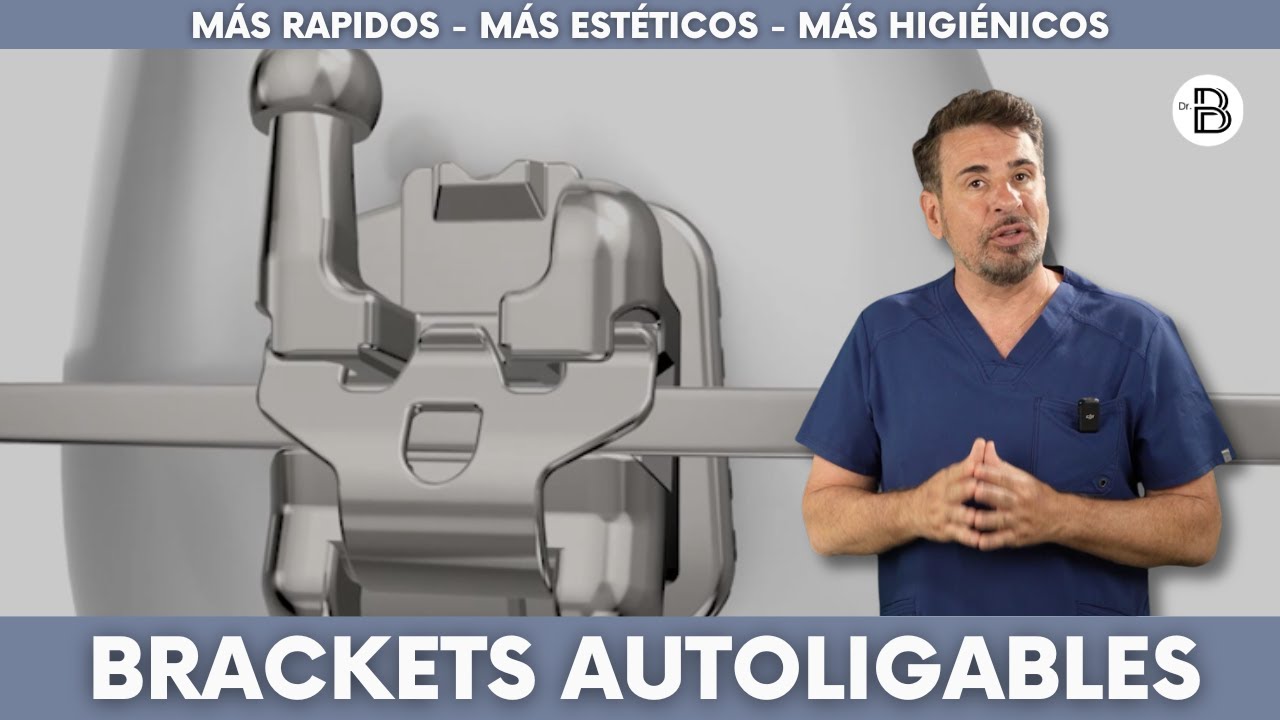 ¿Conoces los BRACKETS AUTOLIGABLES y sus ventajas? - YouTube