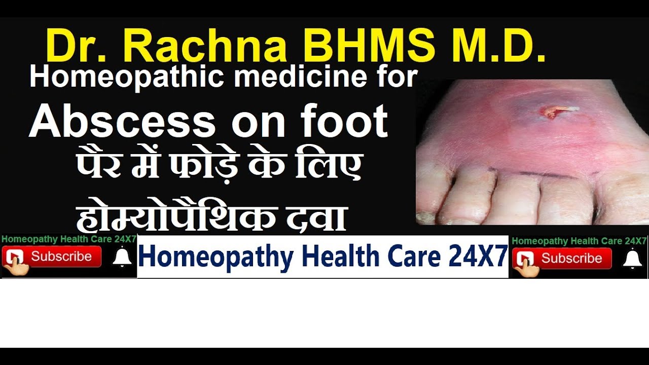 Homeopathy Medicine for Abscess on foot | पैर में फोड़े के लिए ...