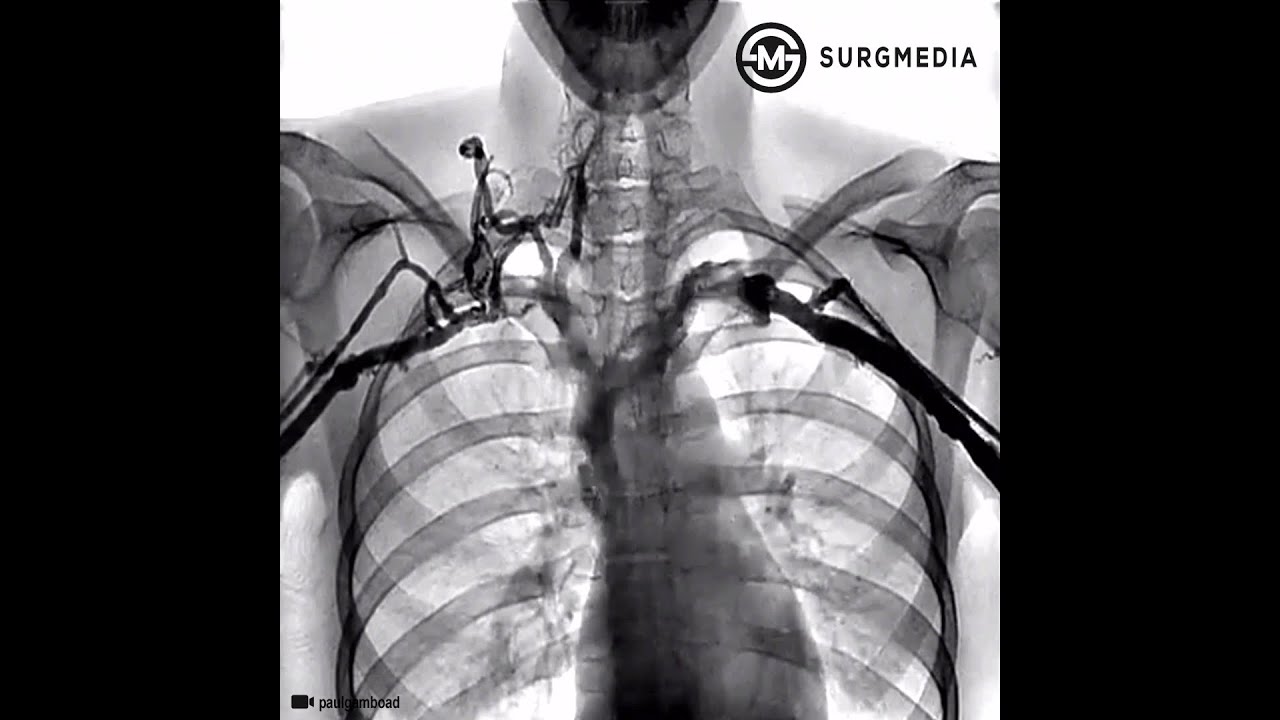 Amazing Rare Footage Shows Real Time Visualization of Venous Thoracic ...