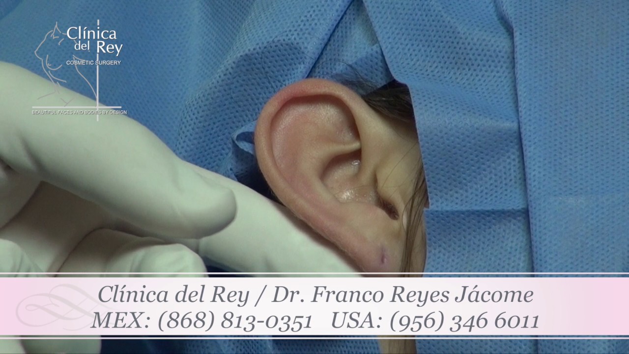 REPARACION LOBULO DE LA OREJA - CLINICA DEL REY DR. FRANCO REYES JACOME ...