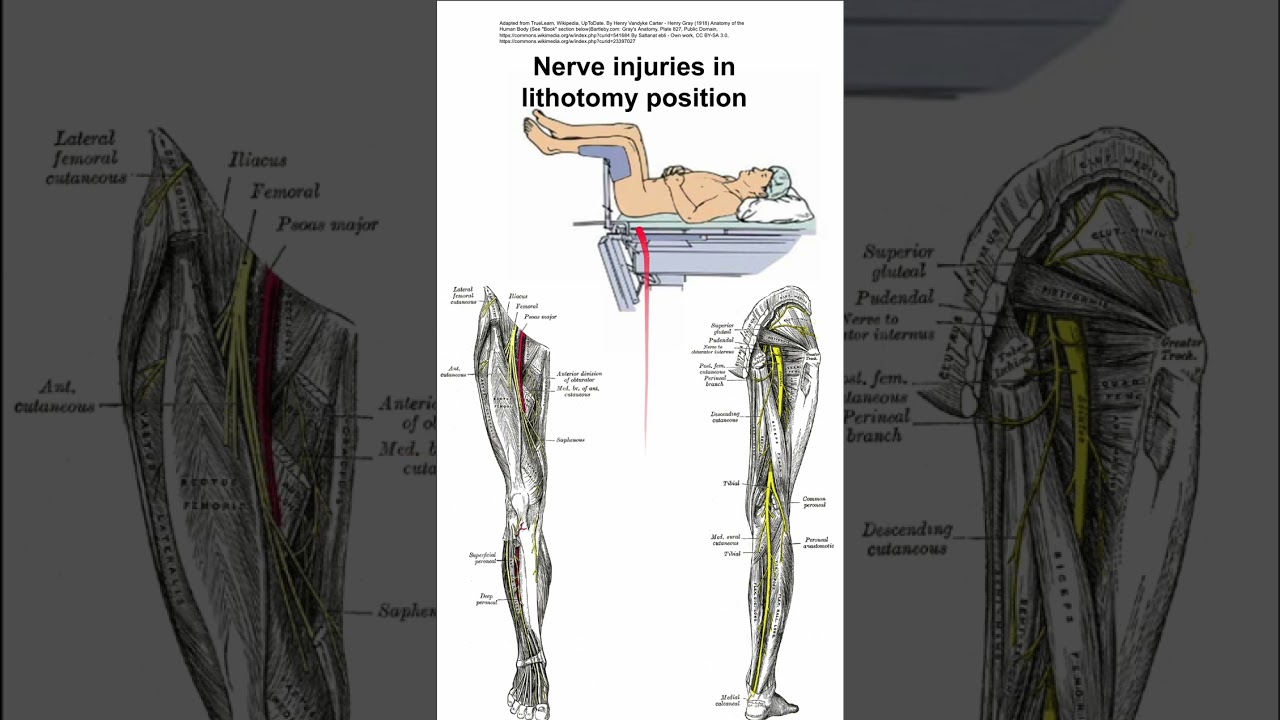 Low Lithotomy Position Fundamentals Of Patient Positioning For Surgery