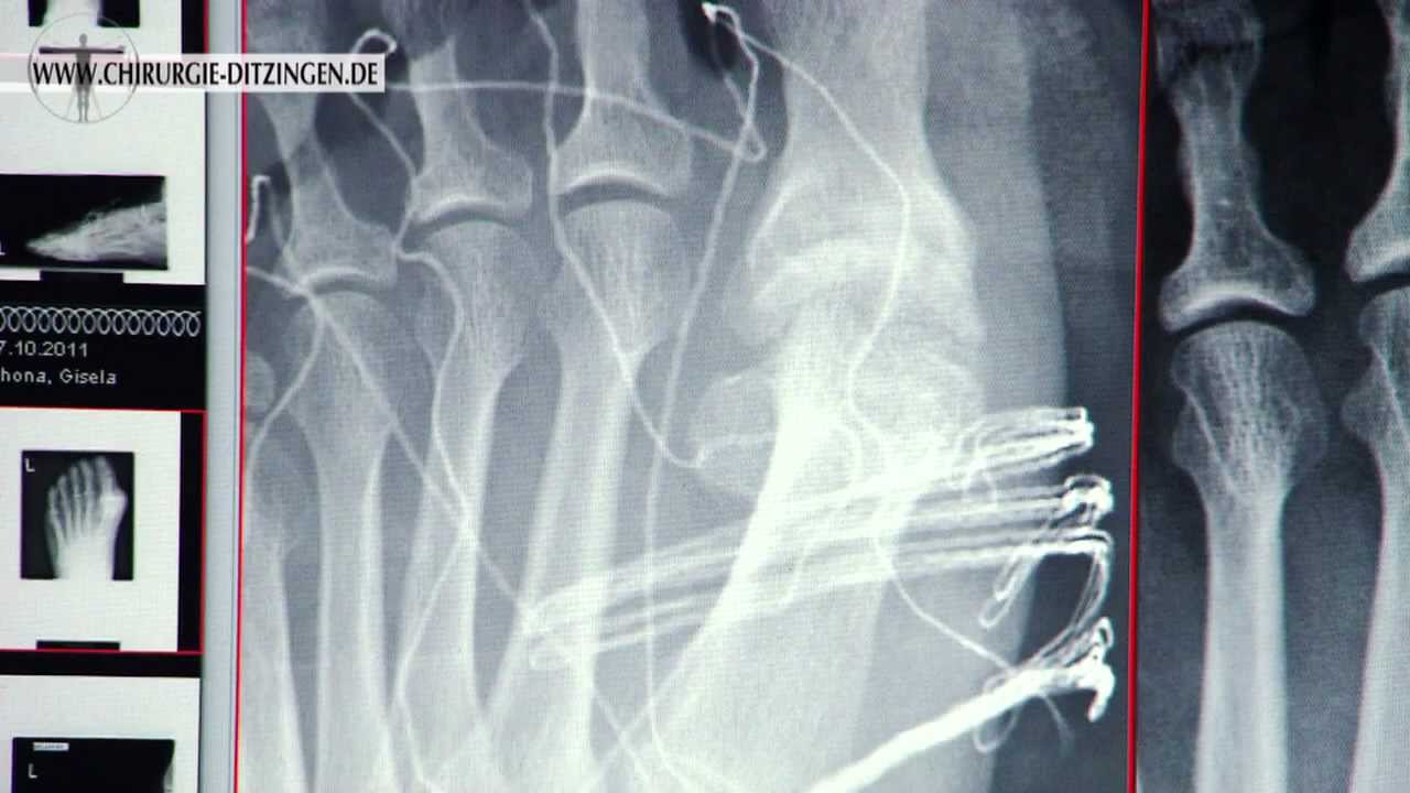 Hallux Rigidus Operation - YouTube