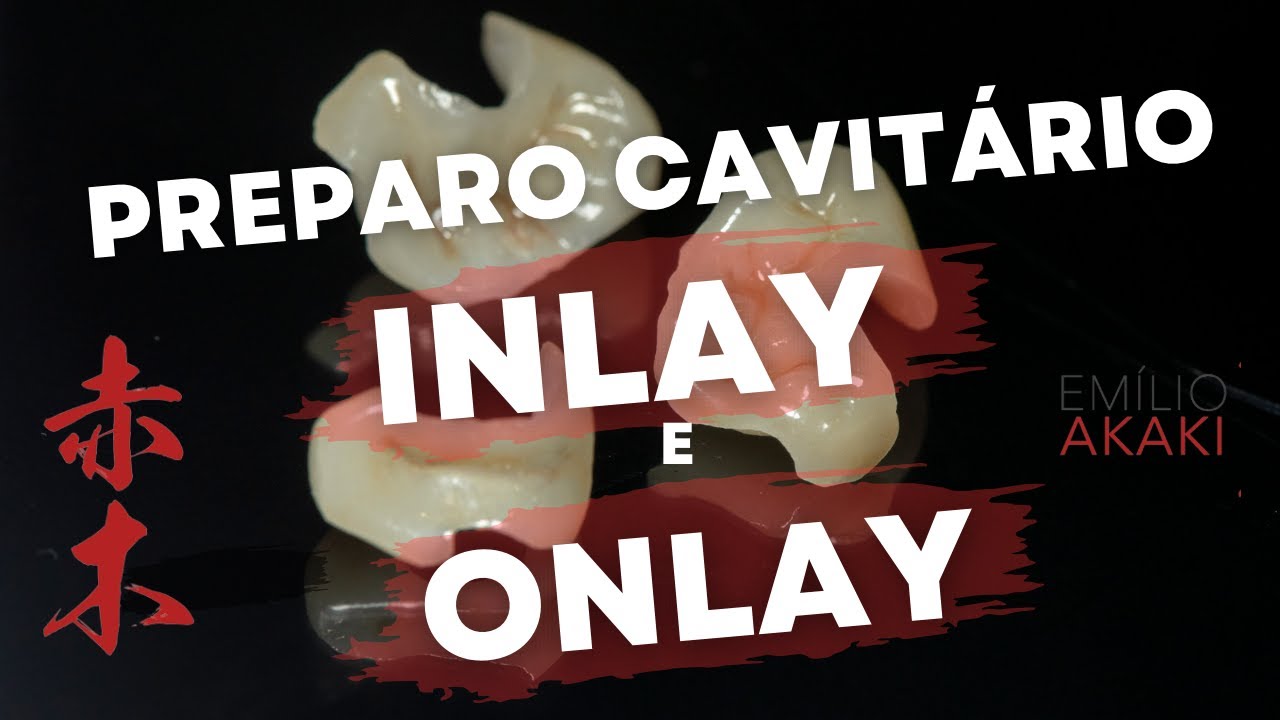 PREPARO CAVITÁRIO INLAY E ONLAY - YouTube