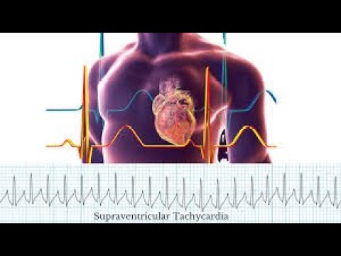 Supraventricular Tachycardia | SVT - types , symptoms, management ...
