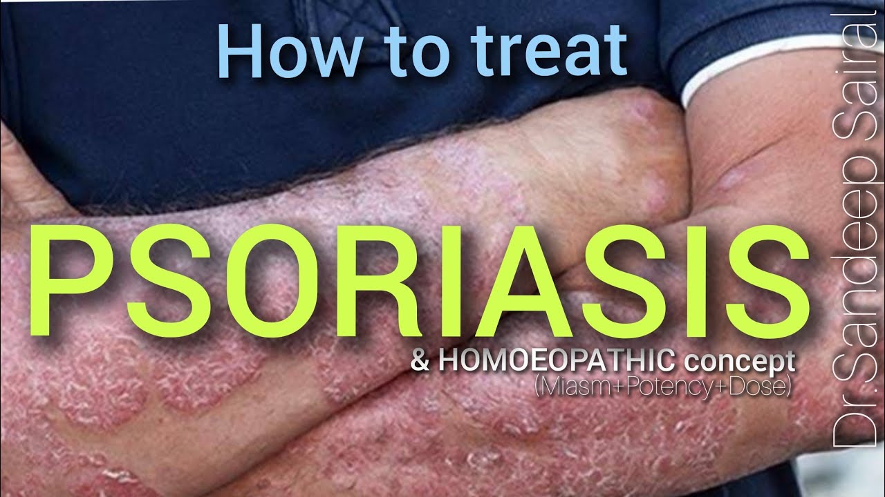 How to treat PSORIASIS with HOMOEOPATHY ~miasm(Dr.Sairal.) - YouTube