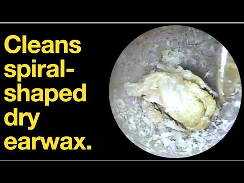 Cleans spiral-shaped dry earwax. |ear wax removal | ear cleaning | ASMR ...