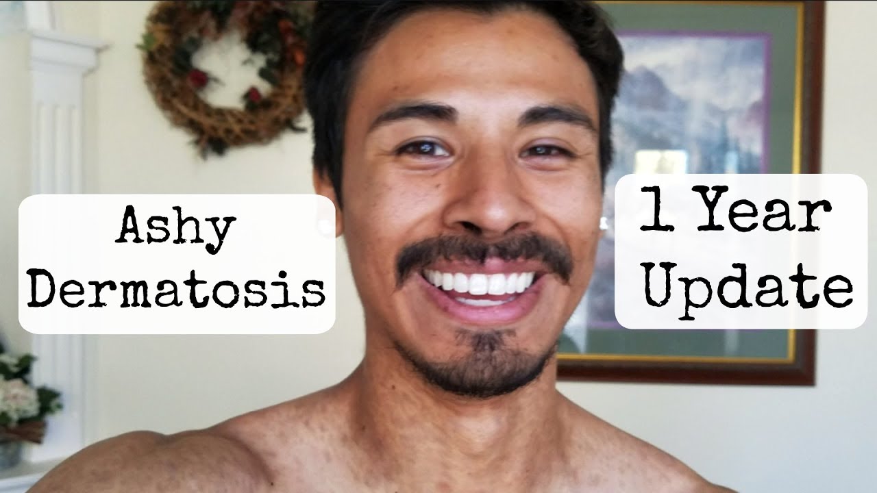 Ashy Dermatosis 1year Update - YouTube