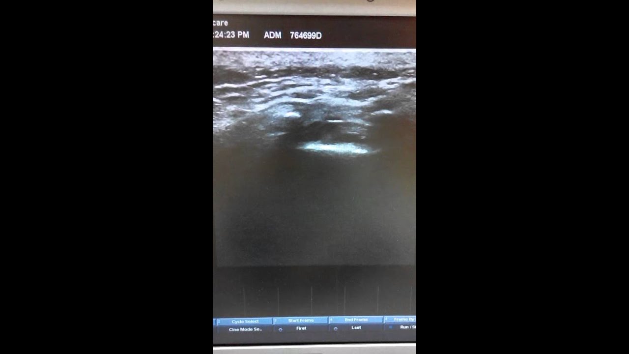 Sono-guided sacral hiatus injection with out-of-plane technique - YouTube