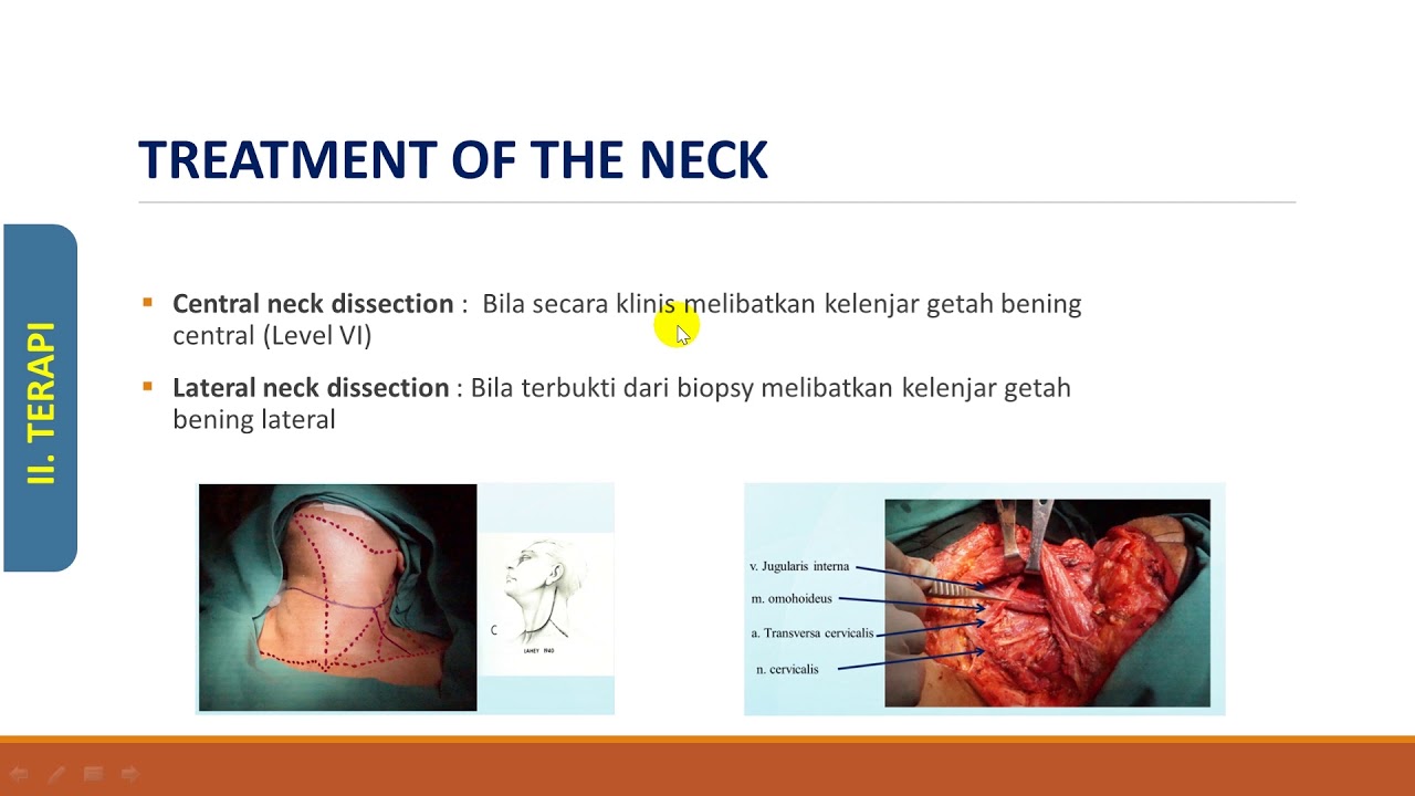 Penatalaksanaan Kanker Tiroid 2 - YouTube