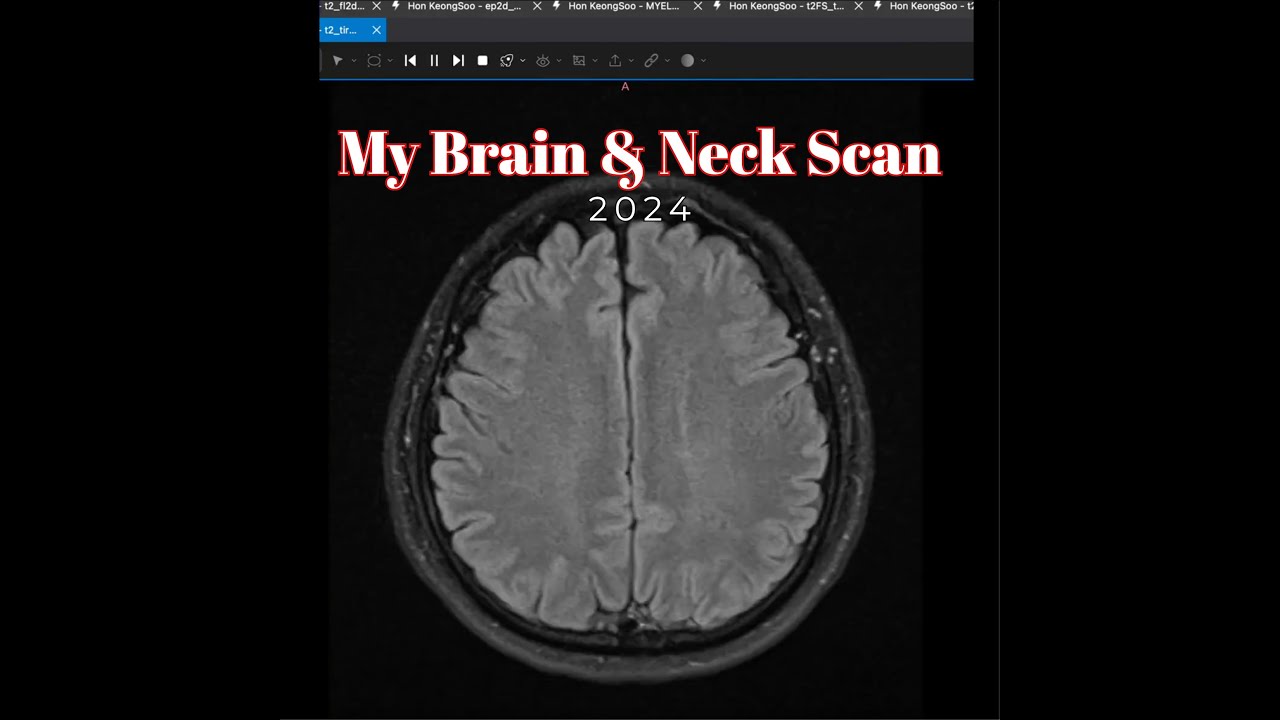 My Brain and Neck scan - YouTube