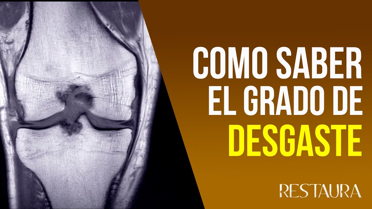 ¿Cómo saber que grado de artrosis de rodilla tengo? - YouTube