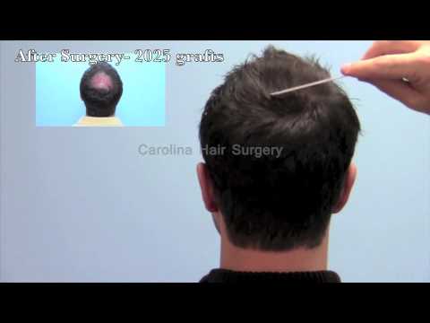 Excellent Hair Transplant of the Crown with FUE Hair Transplant - YouTube