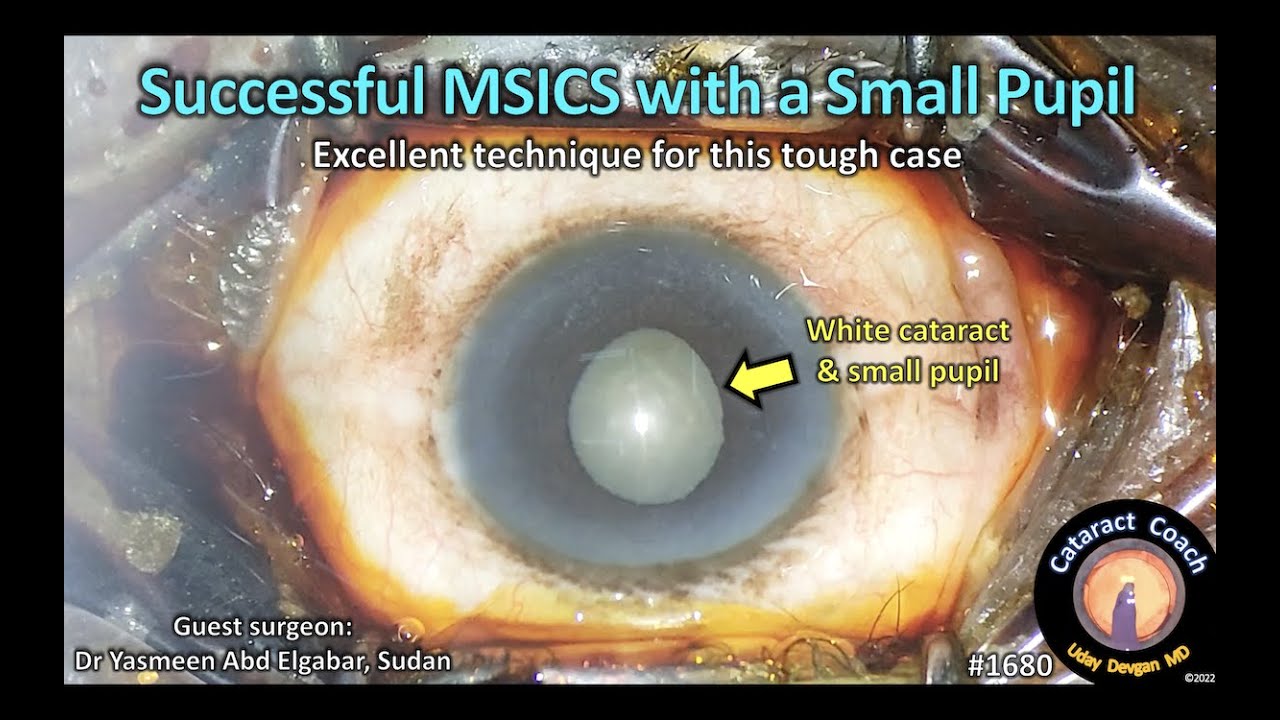 CataractCoach™ 1680: successful MSICS with a small pupil - YouTube