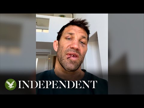 Former UFC champion shows off broken tooth after bare-knuckle match ...