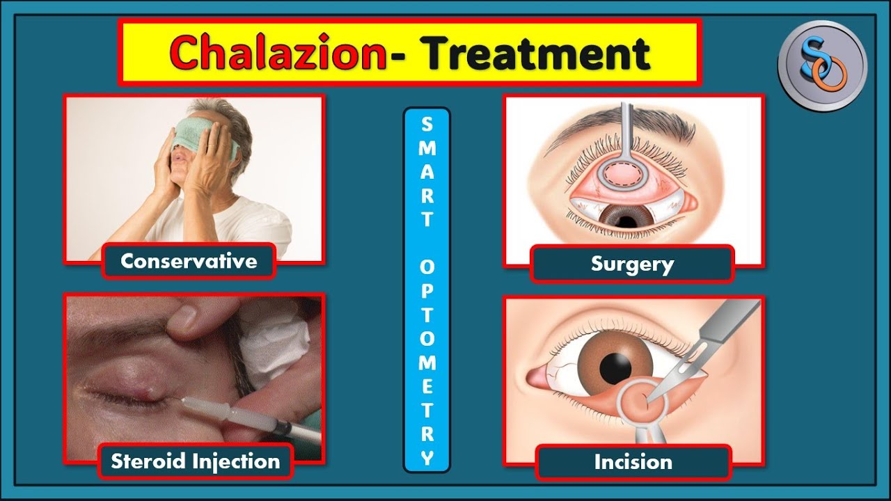 Chalazion- Treatments or Managements of Chalazion. - YouTube