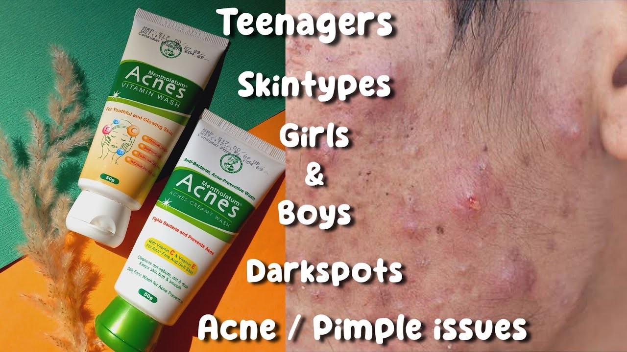 Facewash for acne | Acnes facewash review | pimple solution face wash ...
