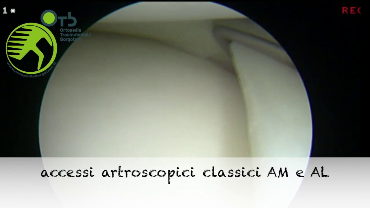 Sutura artroscopica all-inside del menisco mediale - YouTube