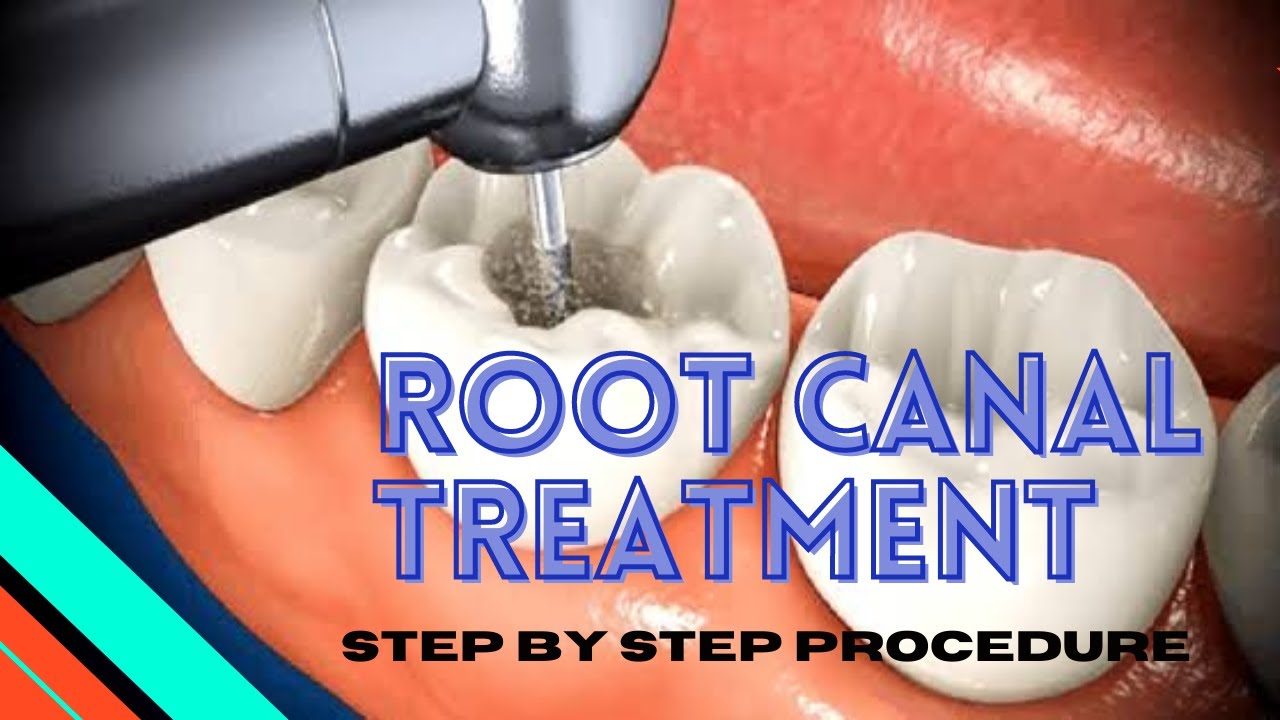 Root Canal Treatment procedure Step by Step | animation video | RCT ...