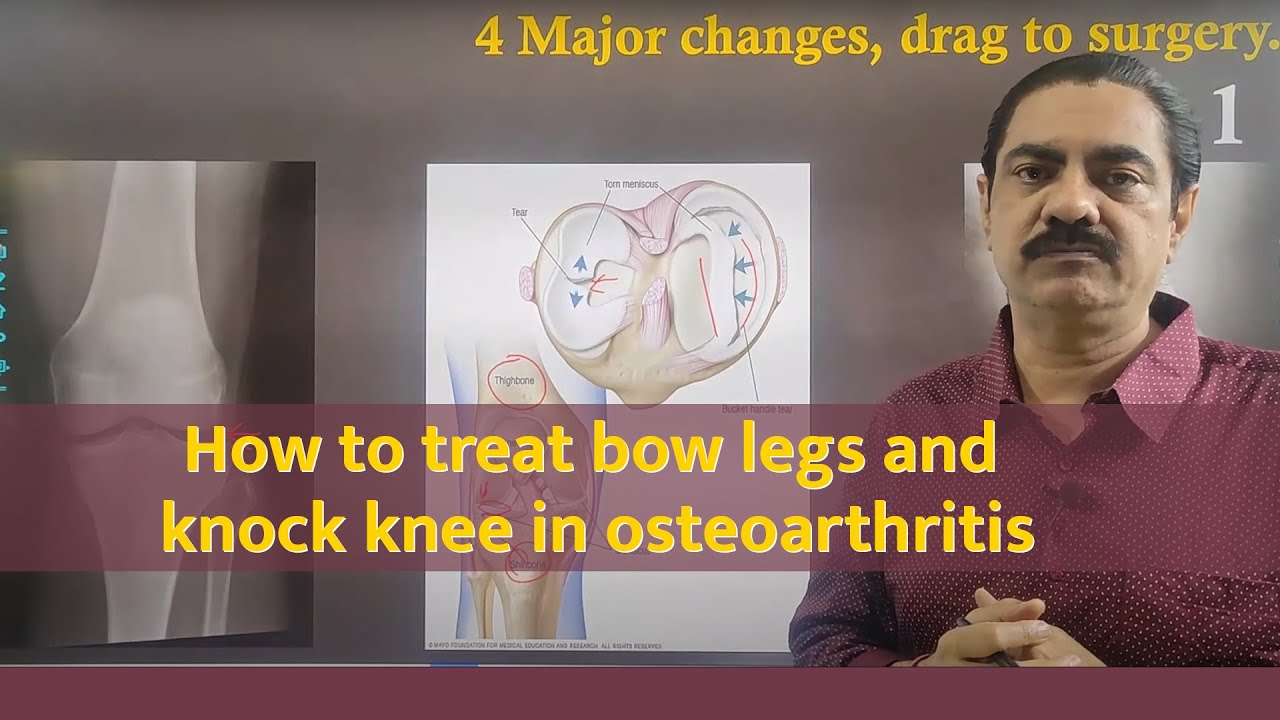 How to treat bow legs and knock knee in osteoarthritis - YouTube