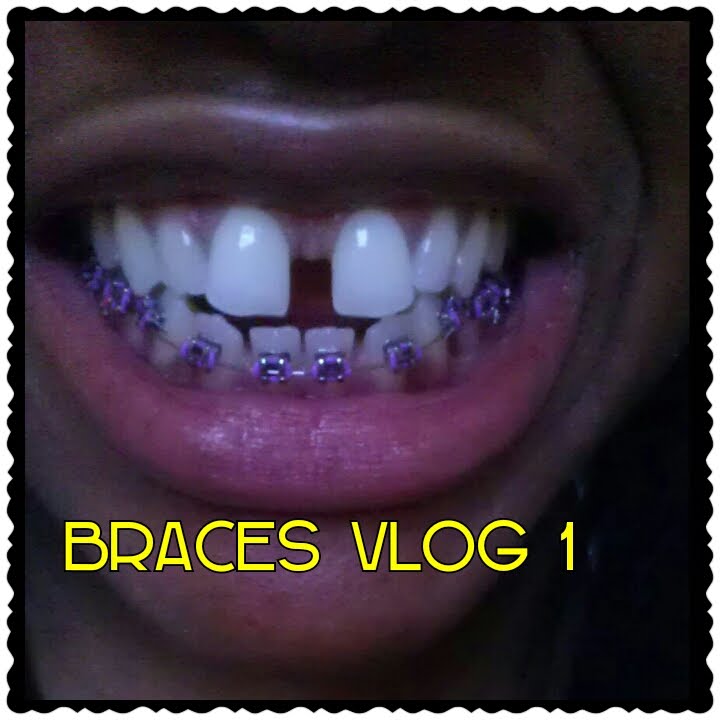 Braces Vlog 1 | Update - YouTube